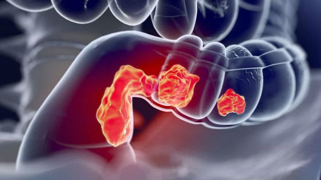 Colonoscopia aos 30 anos para doentes com Síndrome do cancro do cólon ...